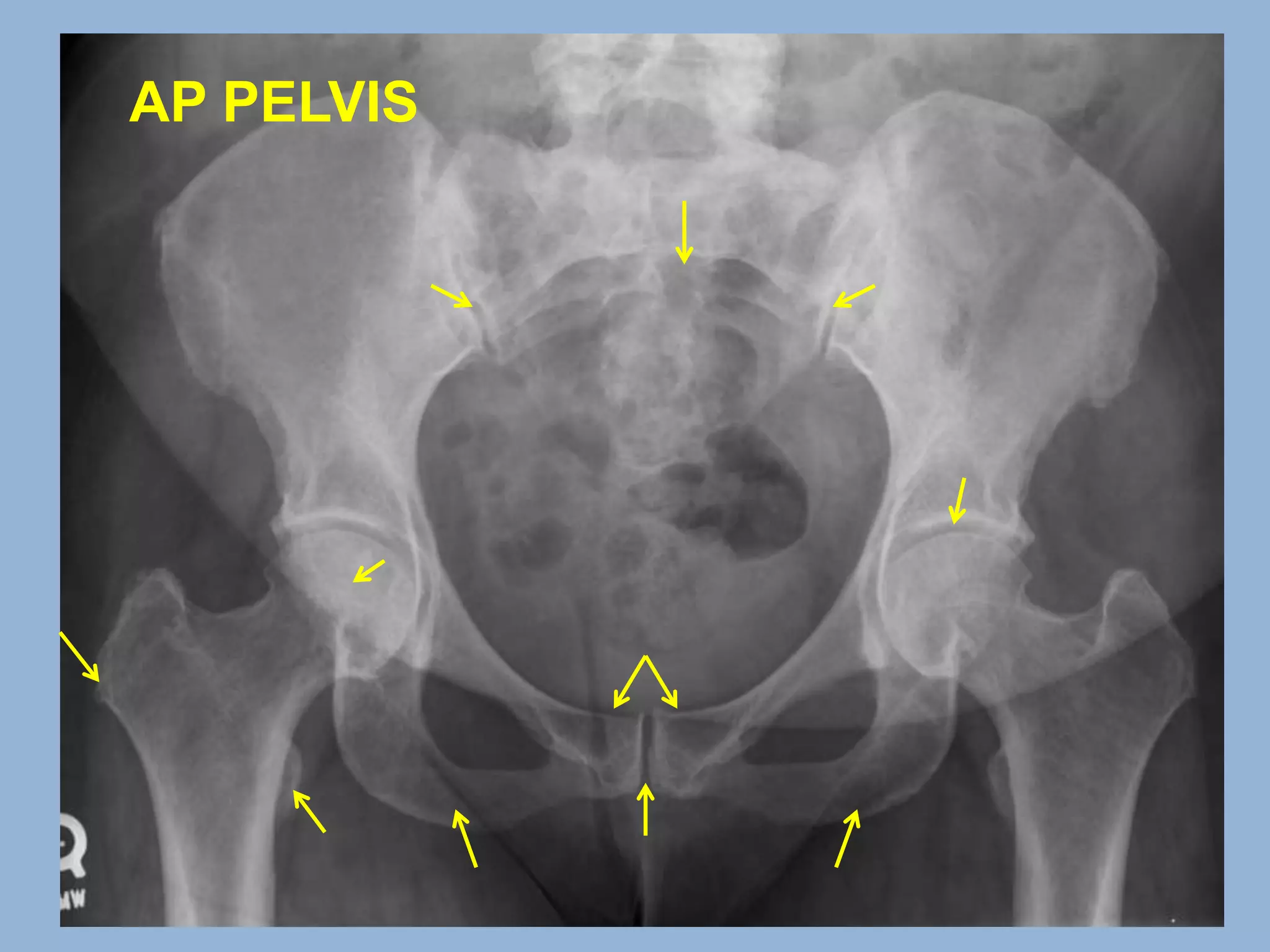 Radiographic anatomy of abd and pelvis r a | PPTX