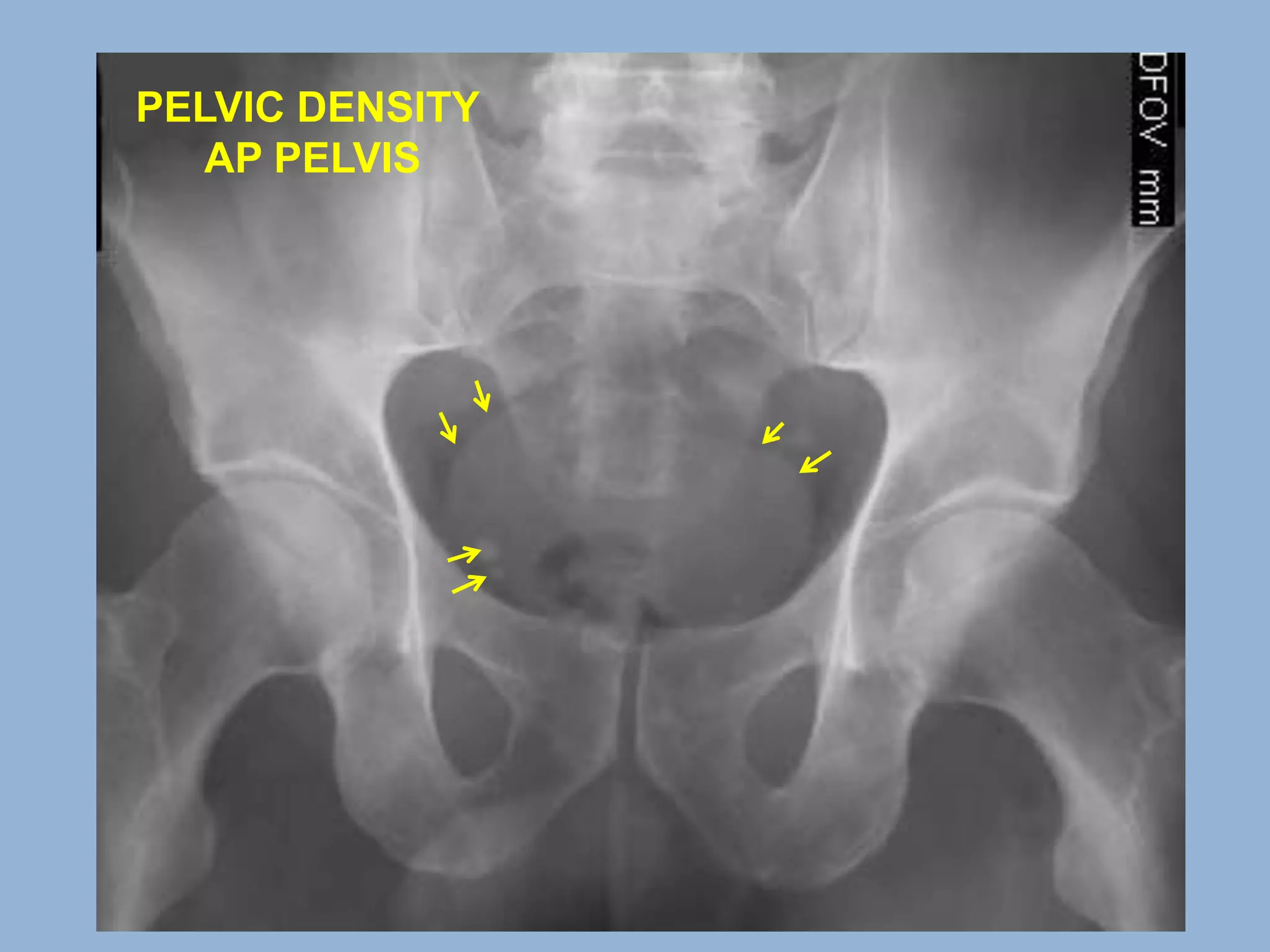Radiographic anatomy of abd and pelvis r a | PPTX