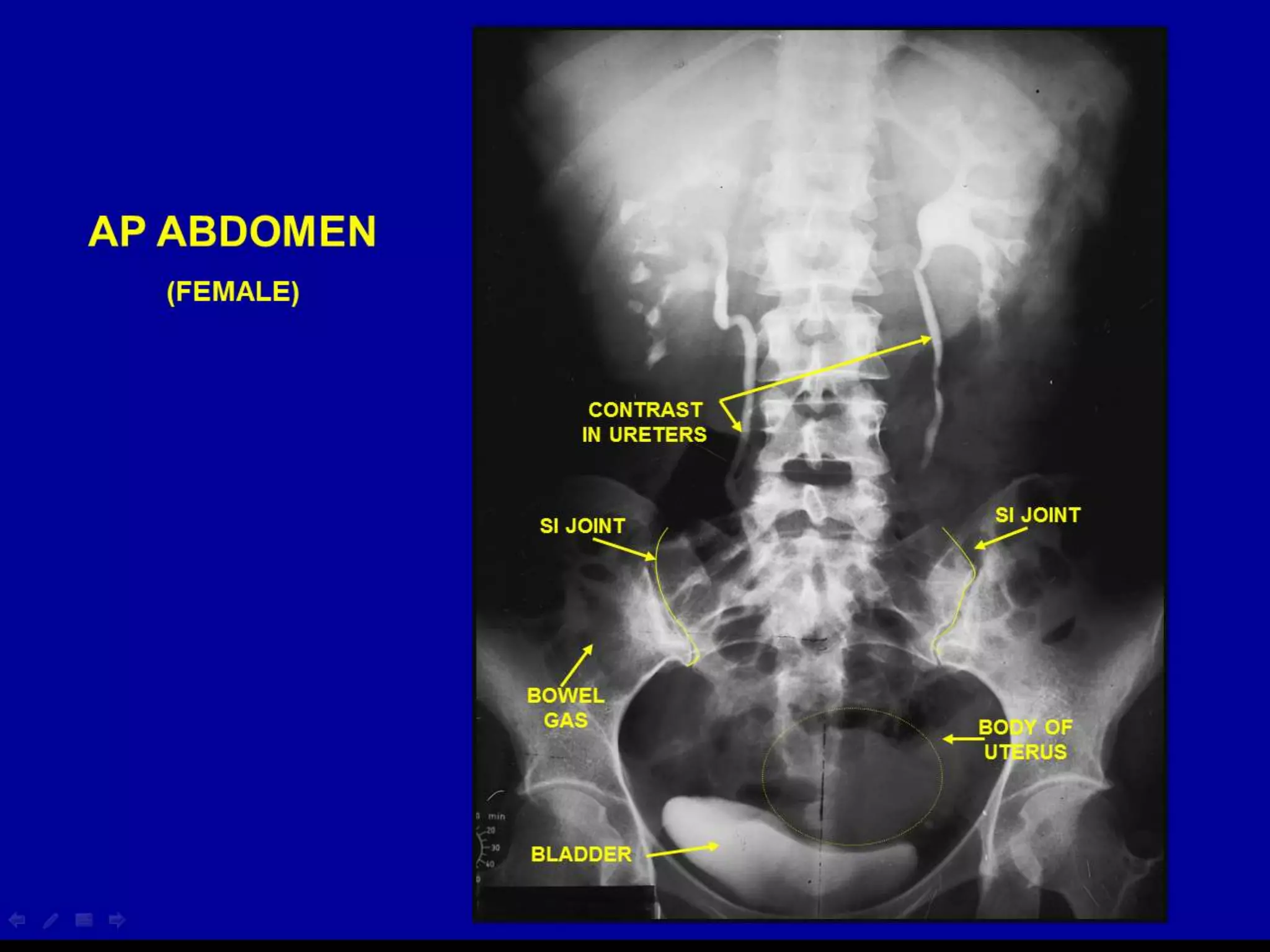 Radiographic anatomy of abd and pelvis r a | PPTX