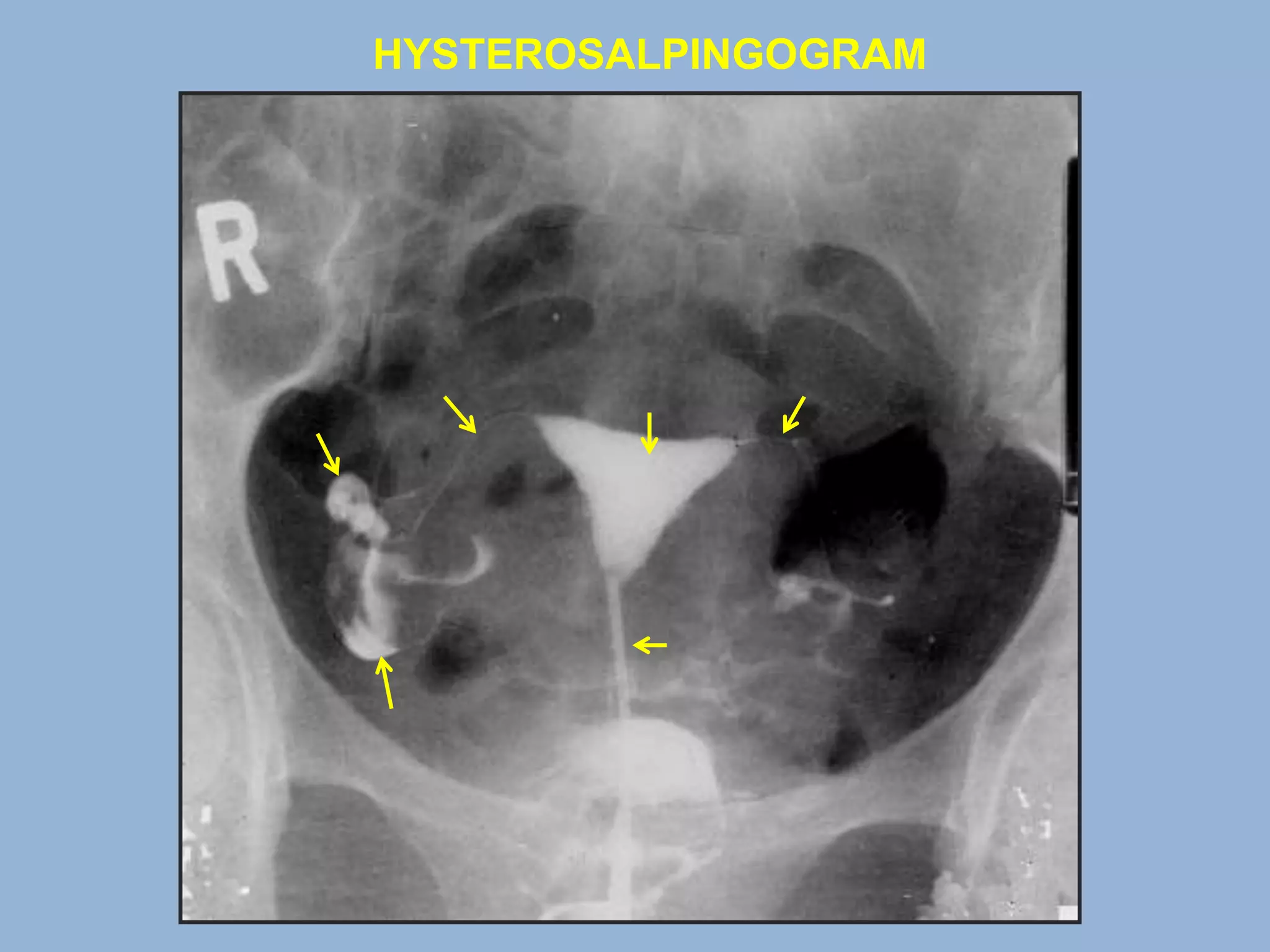 Radiographic anatomy of abd and pelvis r a | PPTX