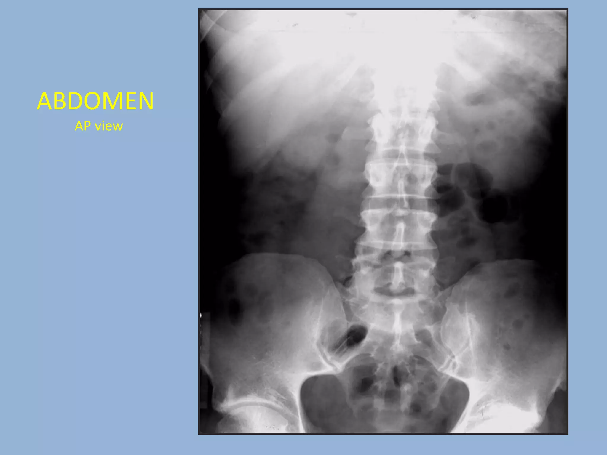 Radiographic anatomy of abd and pelvis r a | PPTX