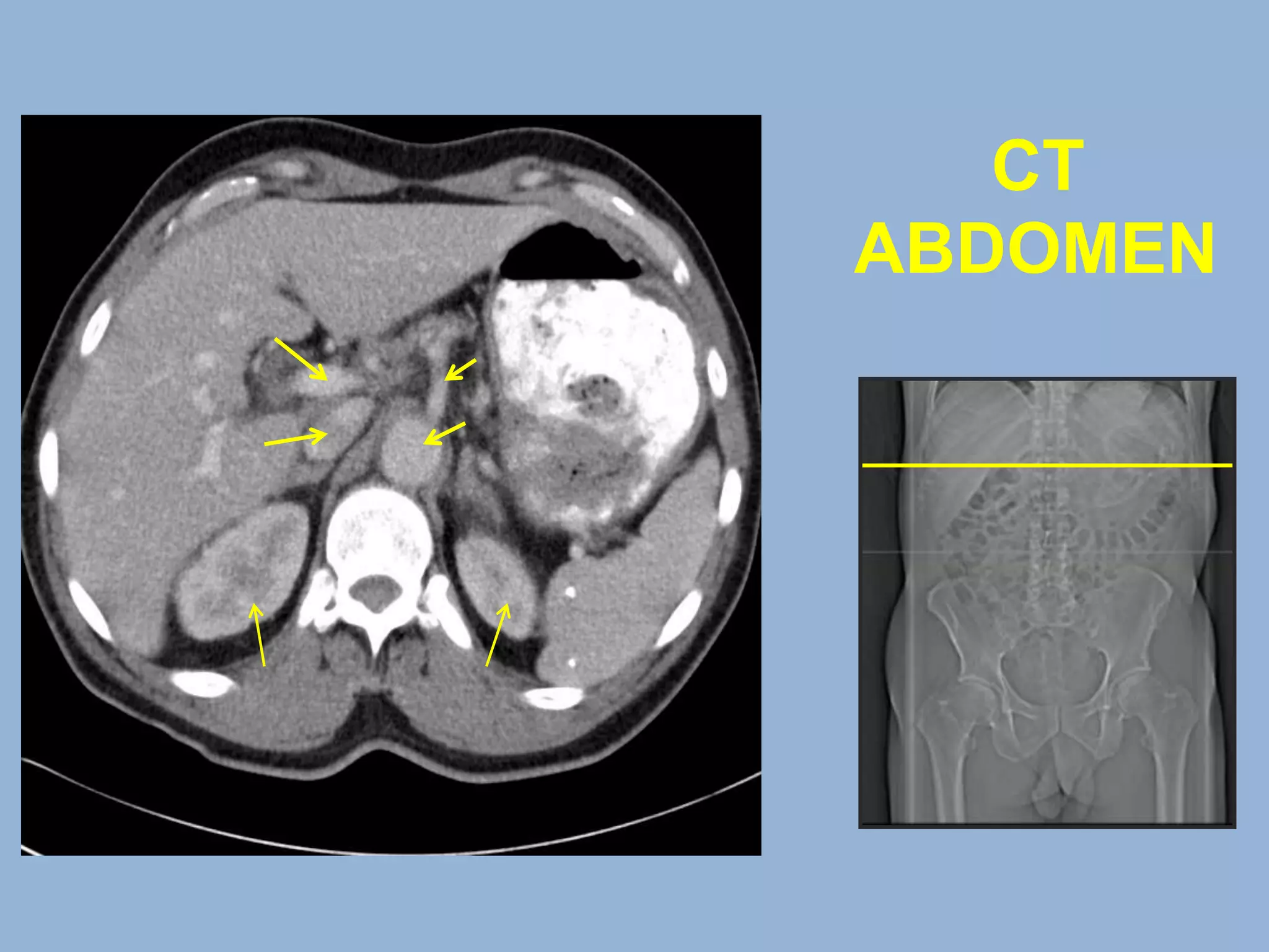 Radiographic anatomy of abd and pelvis r a | PPTX