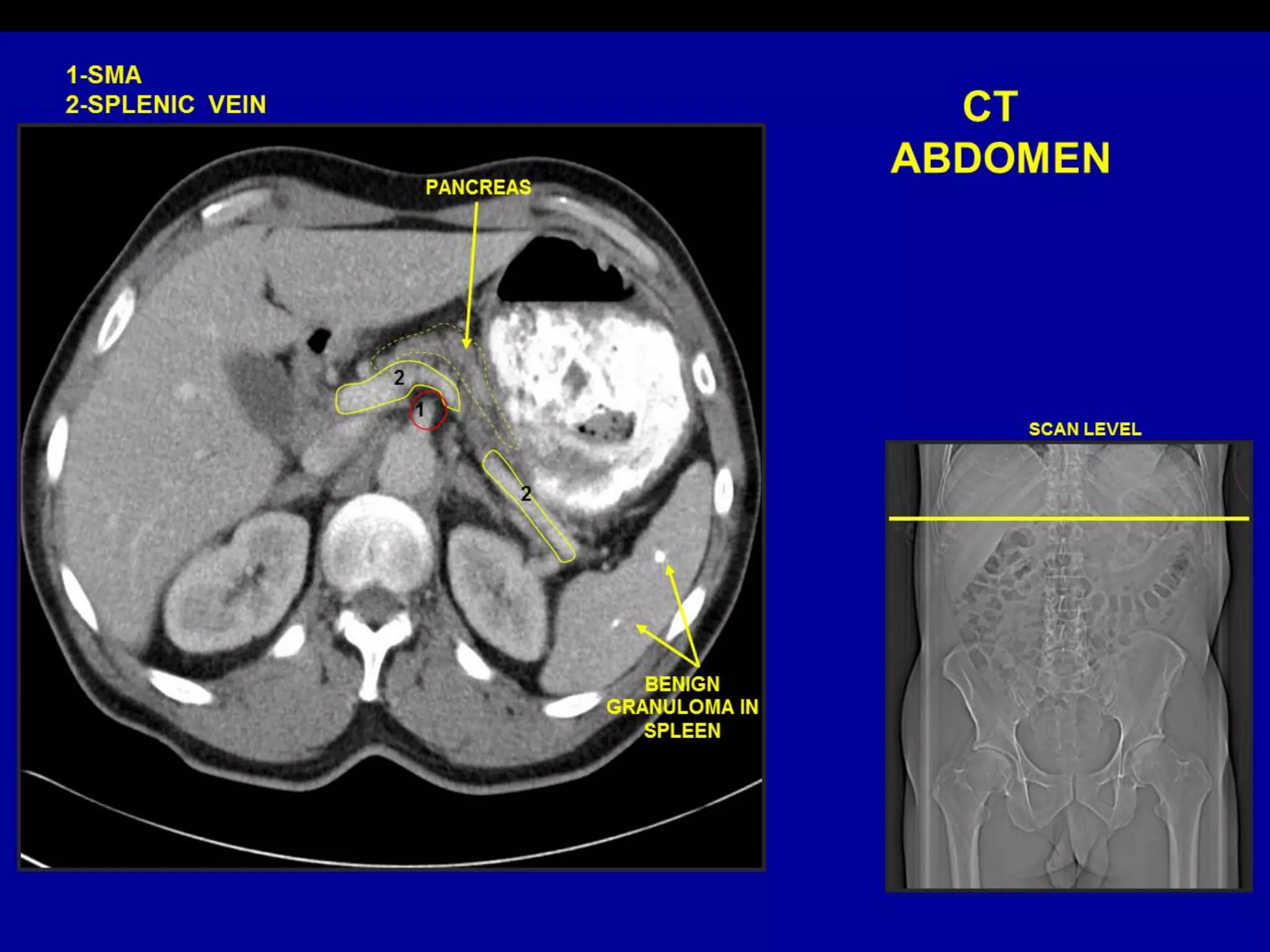 Radiographic anatomy of abd and pelvis r a | PPTX