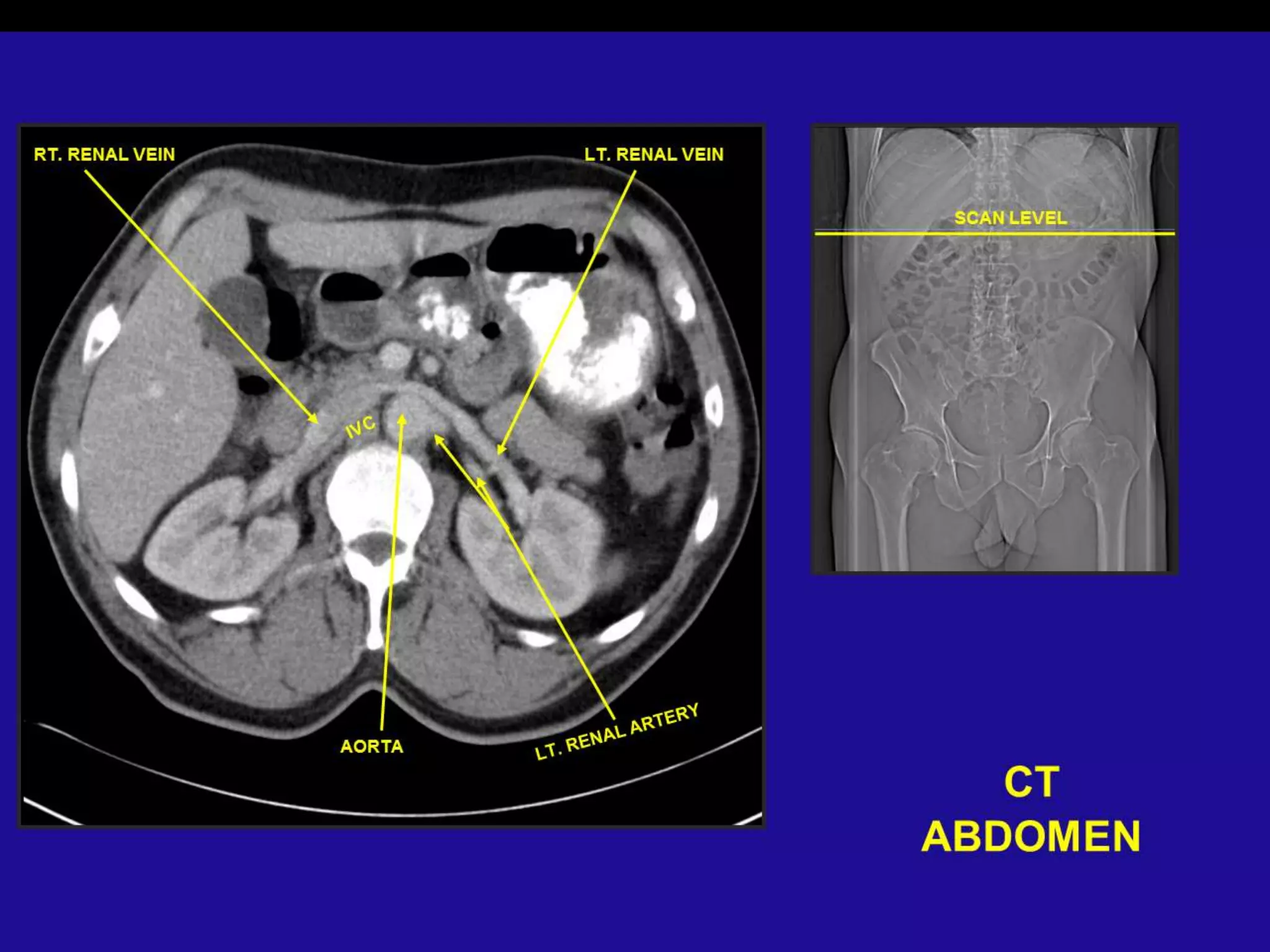 Radiographic anatomy of abd and pelvis r a | PPTX