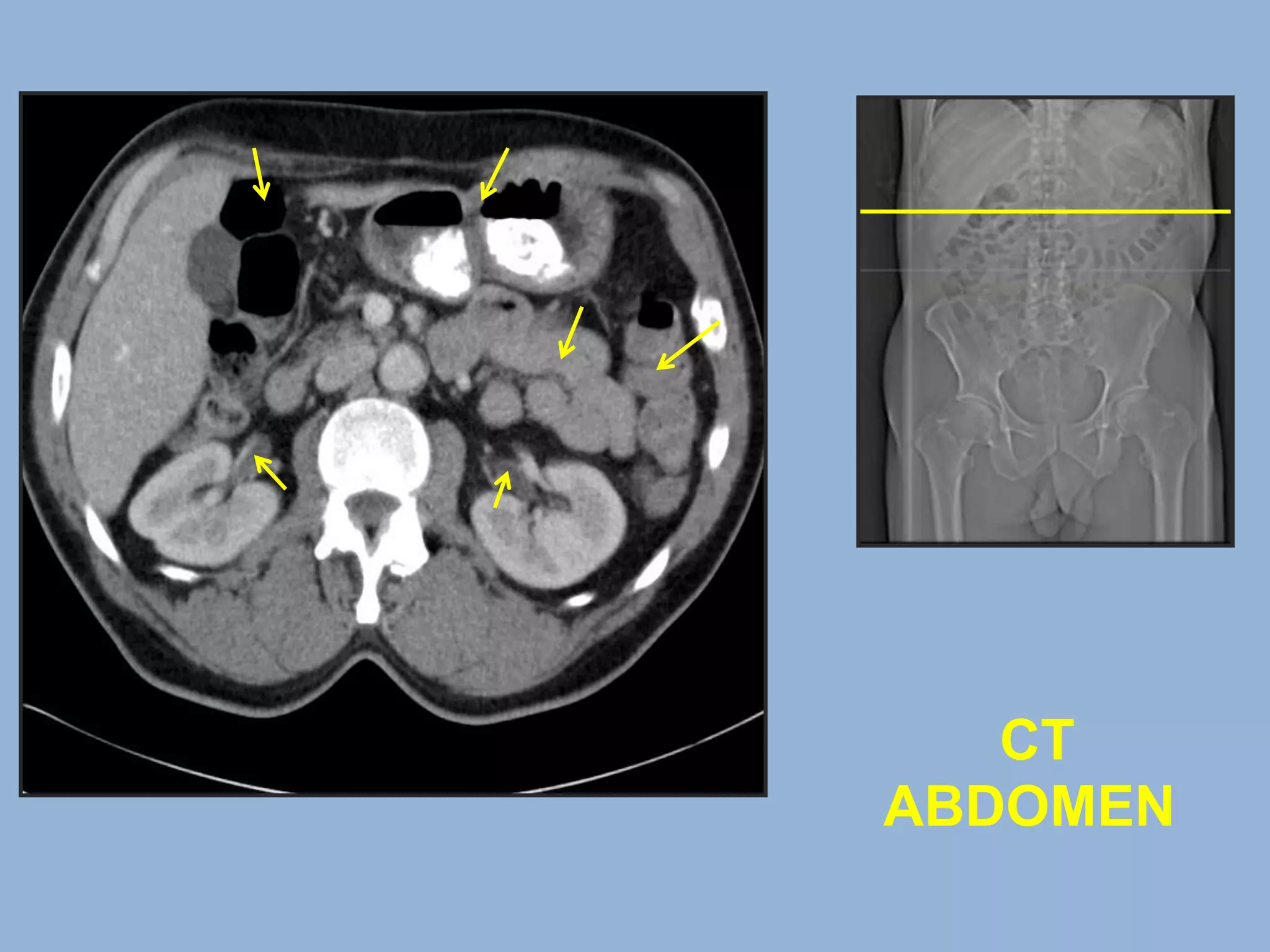 Radiographic anatomy of abd and pelvis r a | PPTX