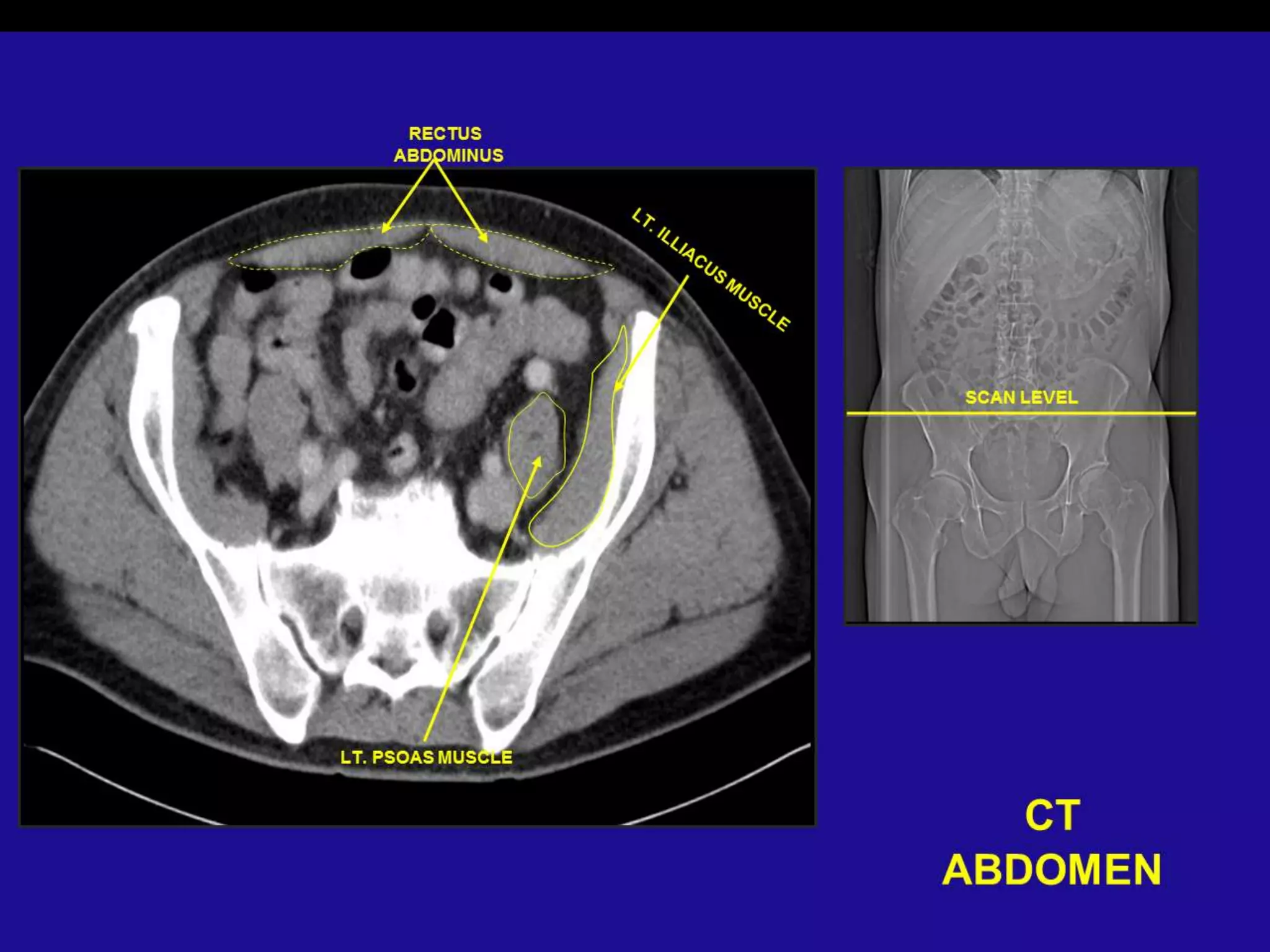 Radiographic anatomy of abd and pelvis r a | PPTX