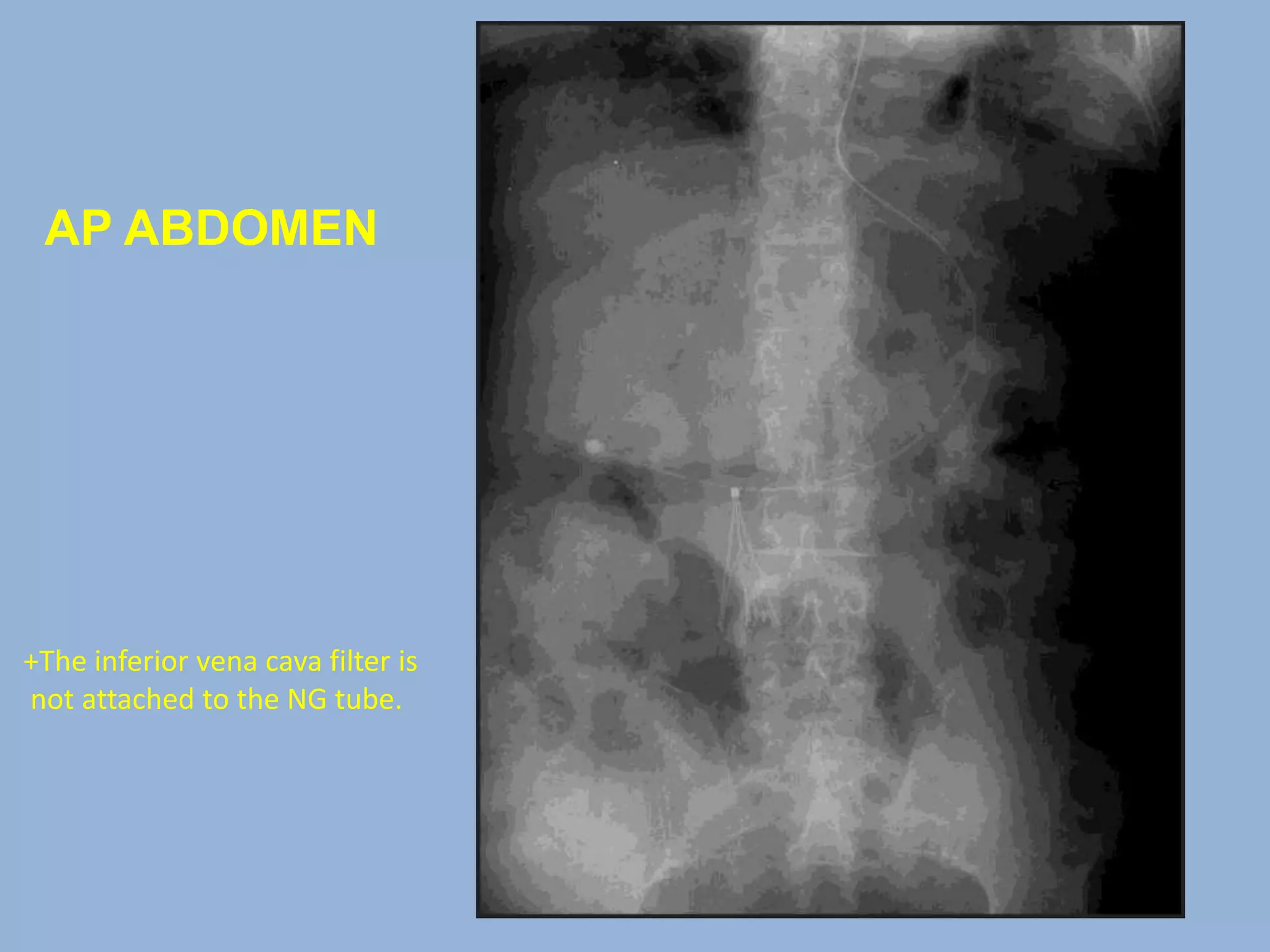 Radiographic anatomy of abd and pelvis r a | PPTX