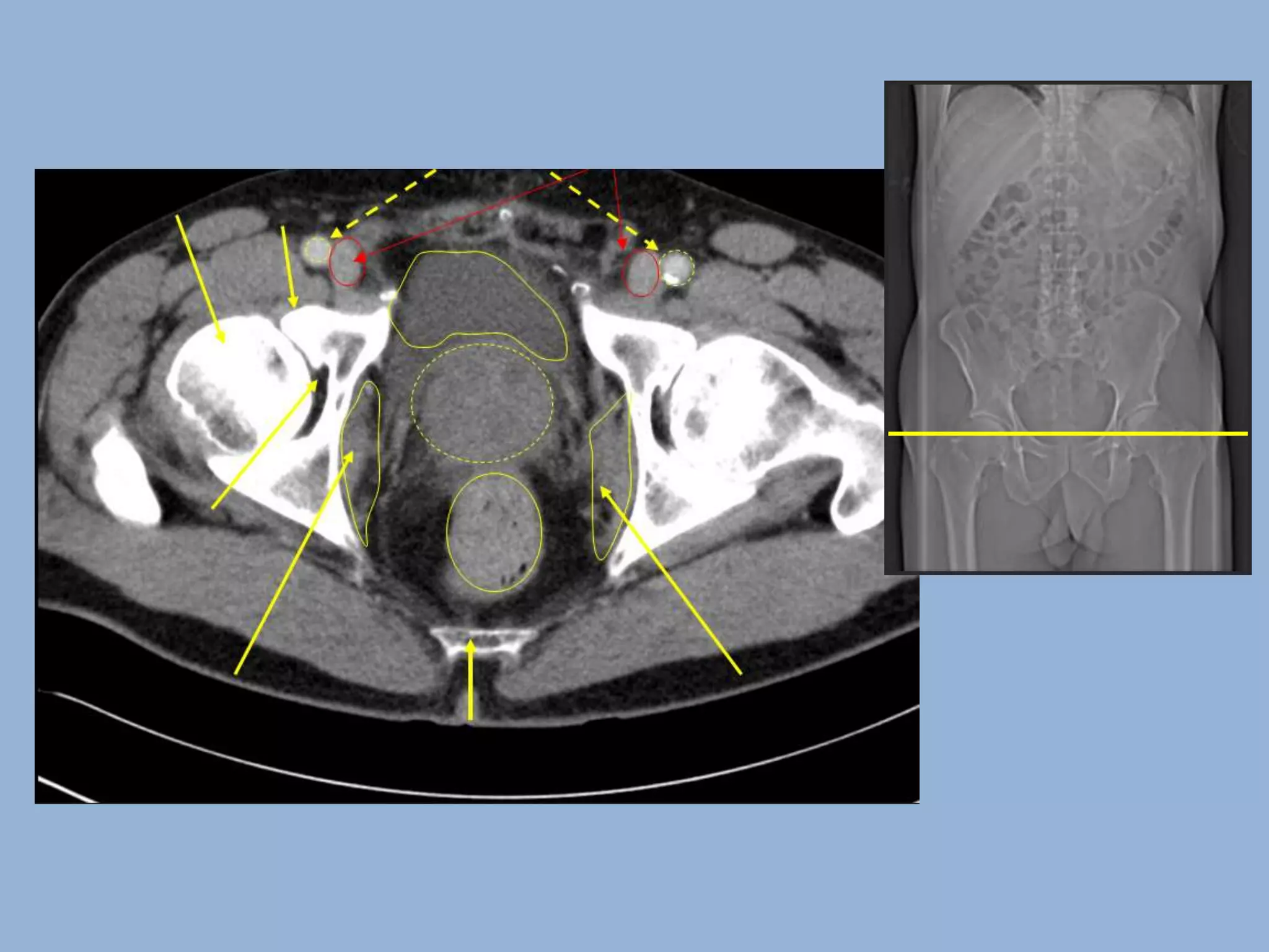 Radiographic anatomy of abd and pelvis r a | PPTX