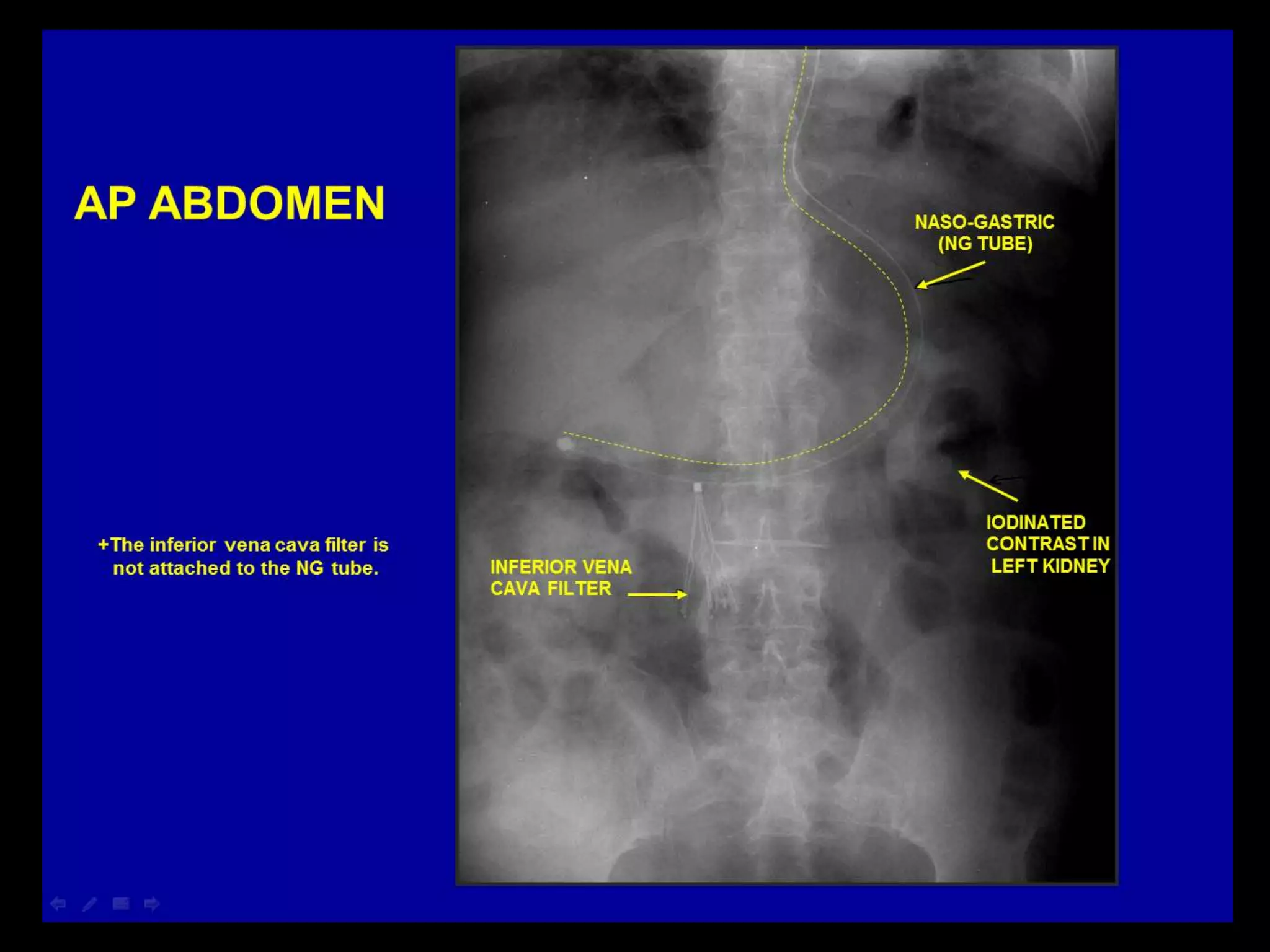Radiographic anatomy of abd and pelvis r a | PPTX