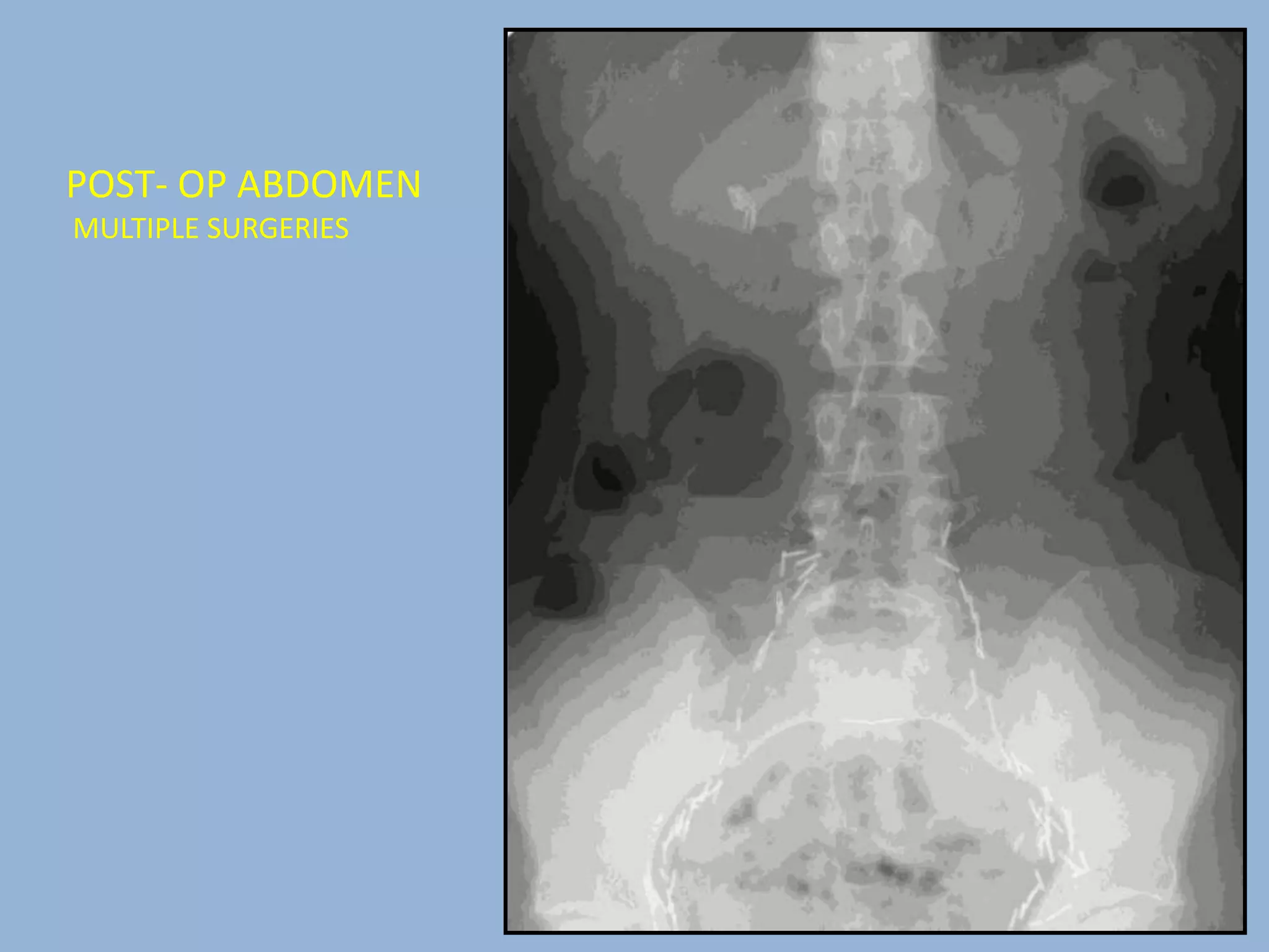 Radiographic anatomy of abd and pelvis r a | PPTX