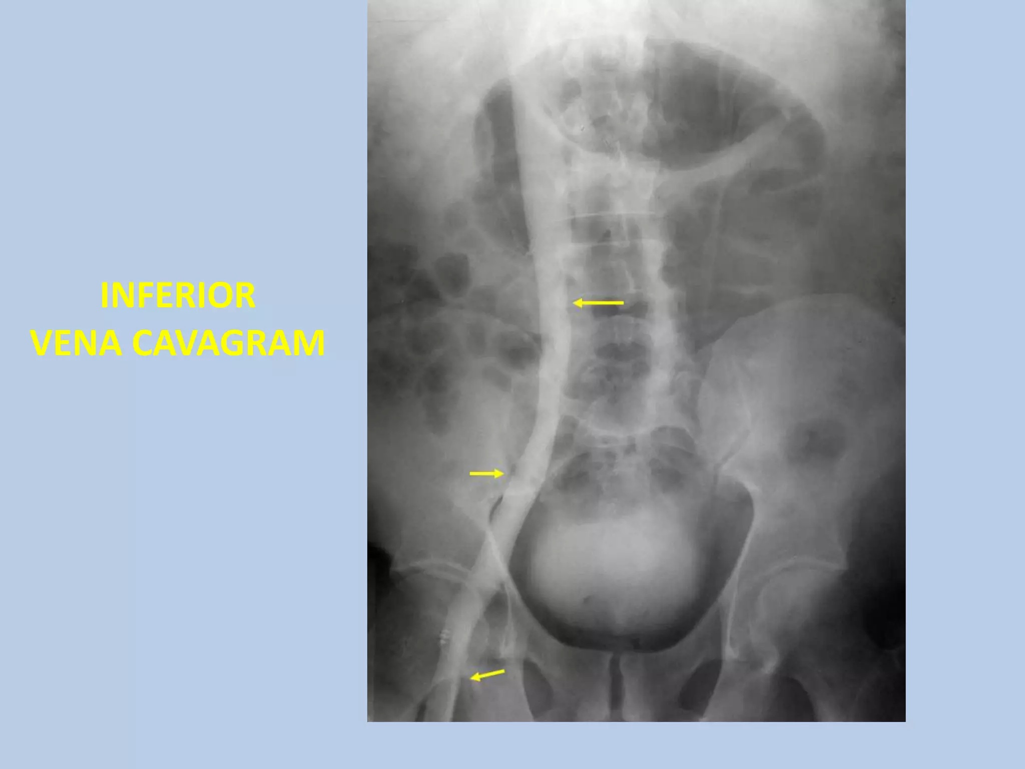 Radiographic anatomy of abd and pelvis r a | PPTX