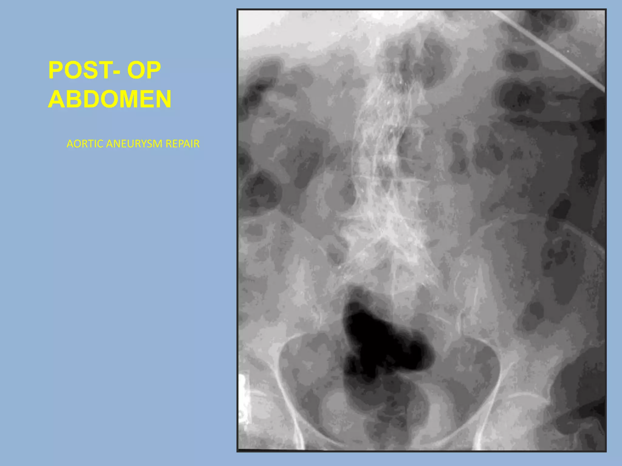 Radiographic anatomy of abd and pelvis r a | PPTX