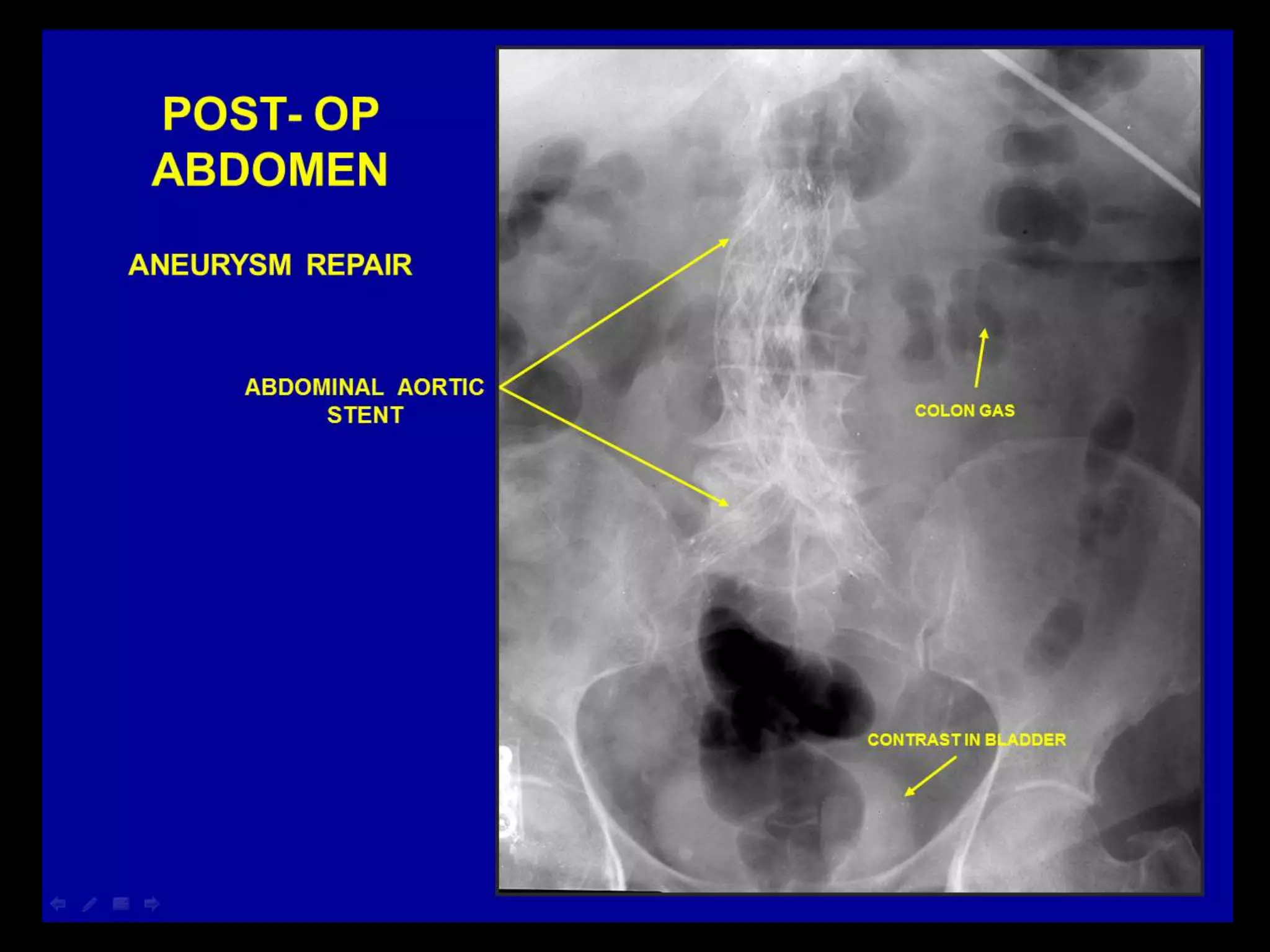 Radiographic anatomy of abd and pelvis r a | PPTX