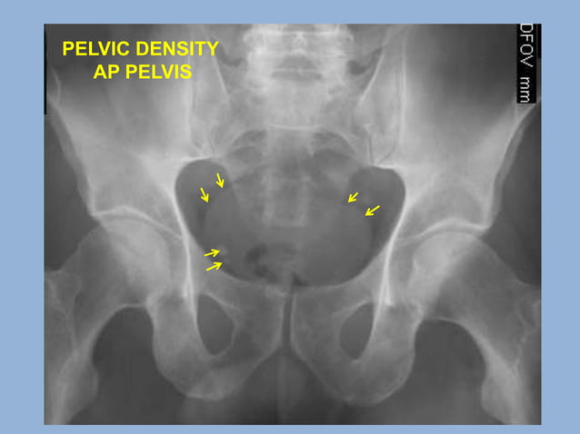 Radiographic anatomy of abd and pelvis r a | PPTX