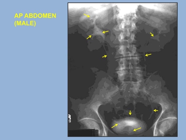Radiographic anatomy of abd and pelvis r a | PPTX