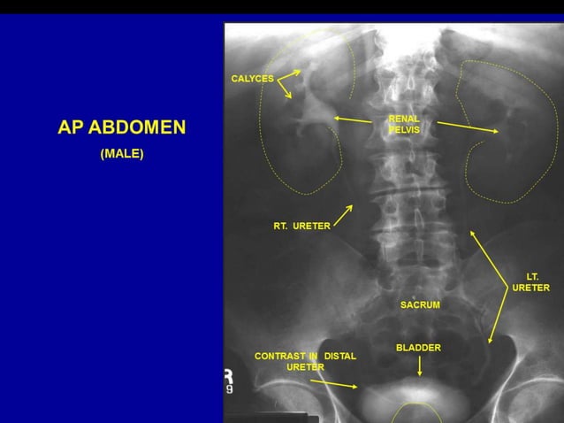 Radiographic anatomy of abd and pelvis r a | PPTX