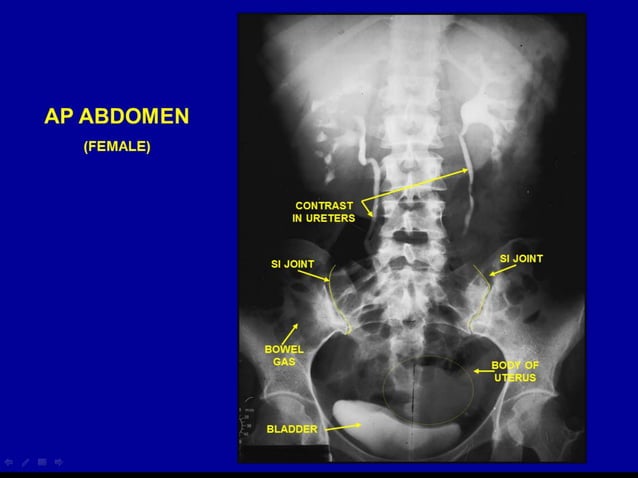 Radiographic anatomy of abd and pelvis r a | PPTX