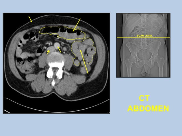 Radiographic anatomy of abd and pelvis r a | PPTX
