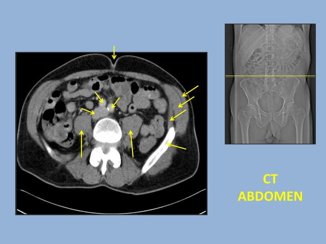 Radiographic anatomy of abd and pelvis r a | PPTX