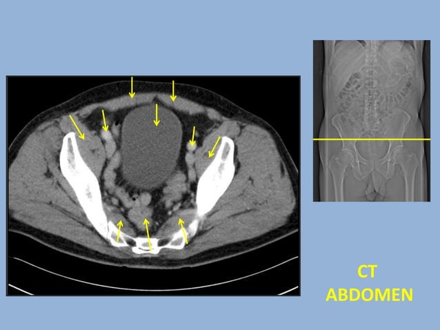 Radiographic anatomy of abd and pelvis r a | PPTX