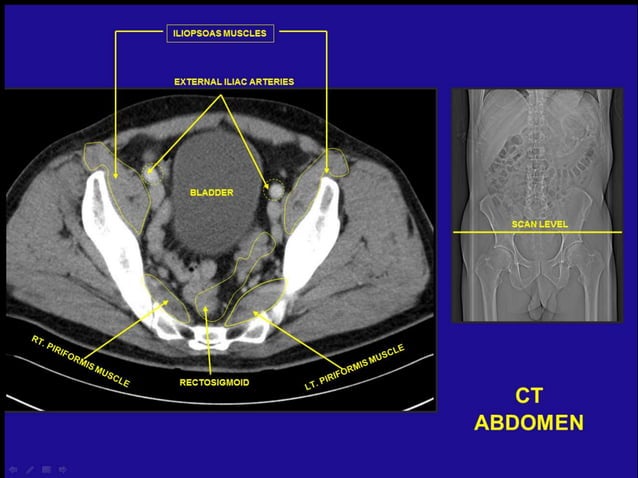 Radiographic anatomy of abd and pelvis r a | PPTX