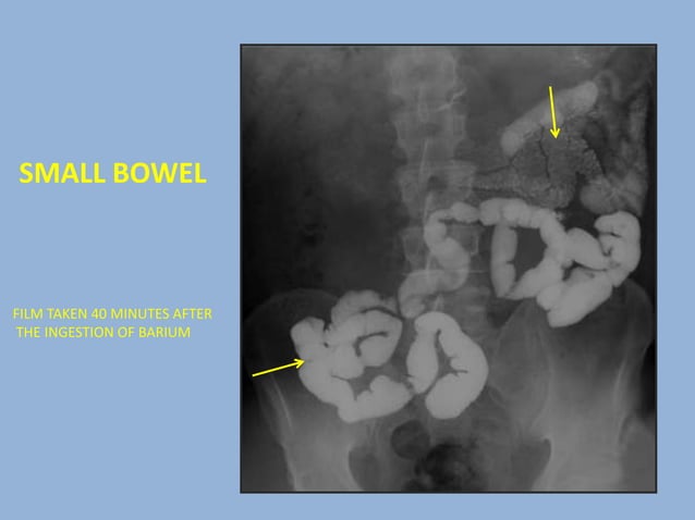 Radiographic anatomy of abd and pelvis r a | PPTX