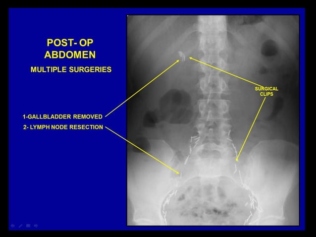 Radiographic anatomy of abd and pelvis r a | PPTX