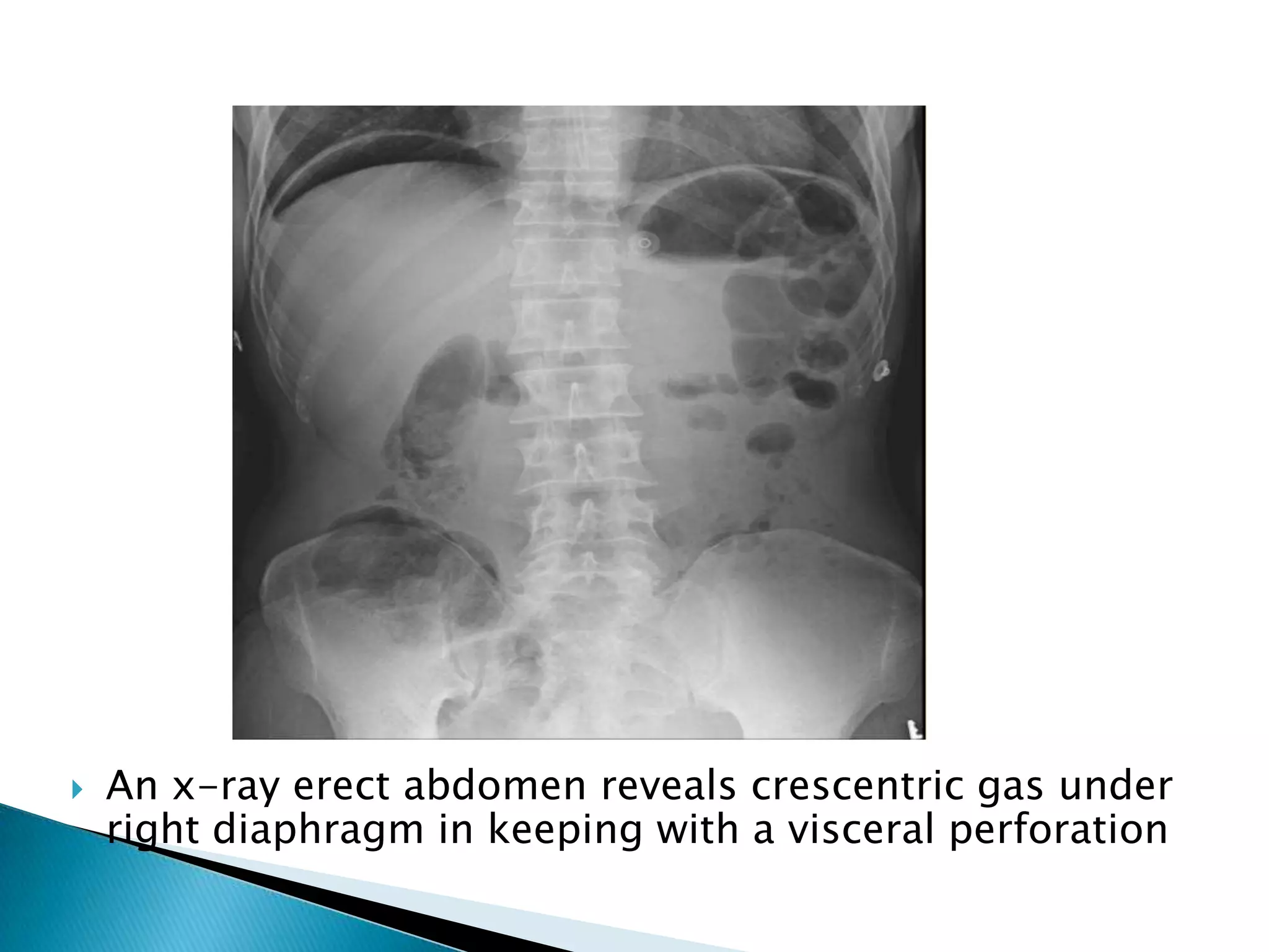 Radiographic anatomy of gastrointestinal tract | PPTX