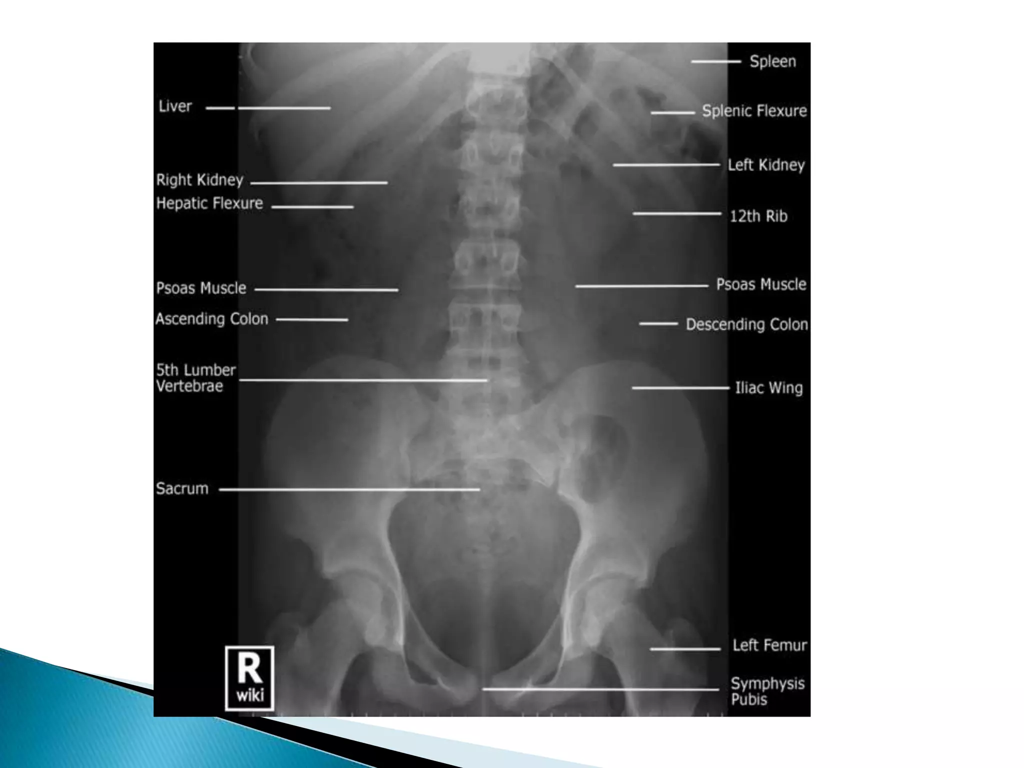 Radiographic anatomy of gastrointestinal tract | PPTX