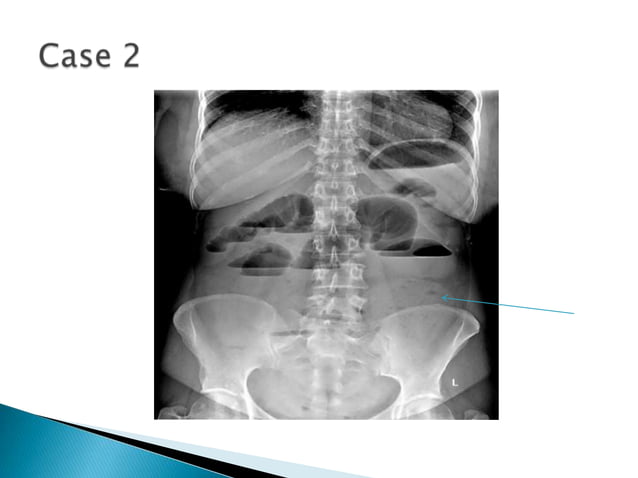 Radiographic anatomy of gastrointestinal tract