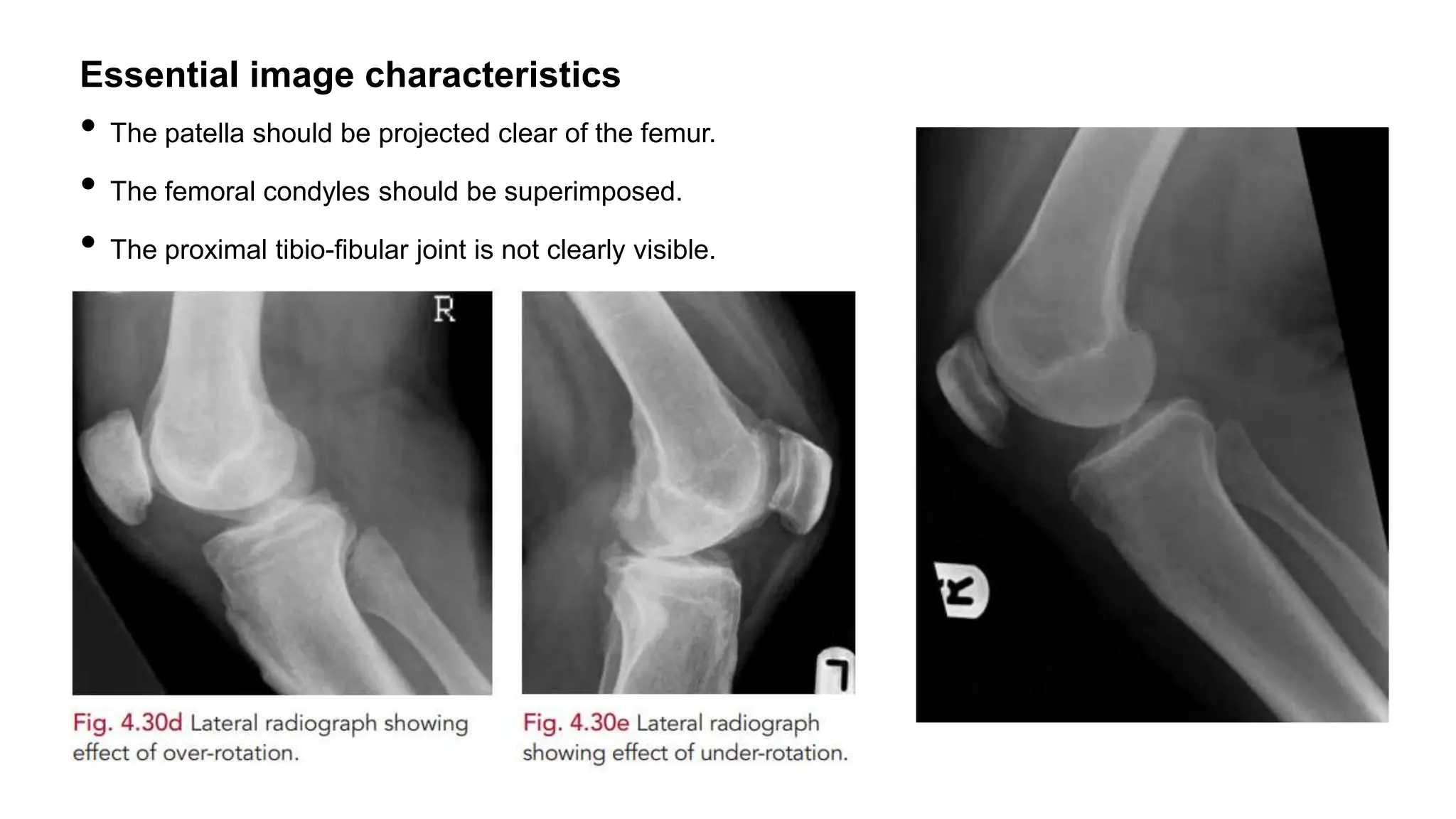 RADIOGRAPHIC ANATOMY OF KNEE JOINT AND ITS RADIOGRAPHIC VIEWS.pptx
