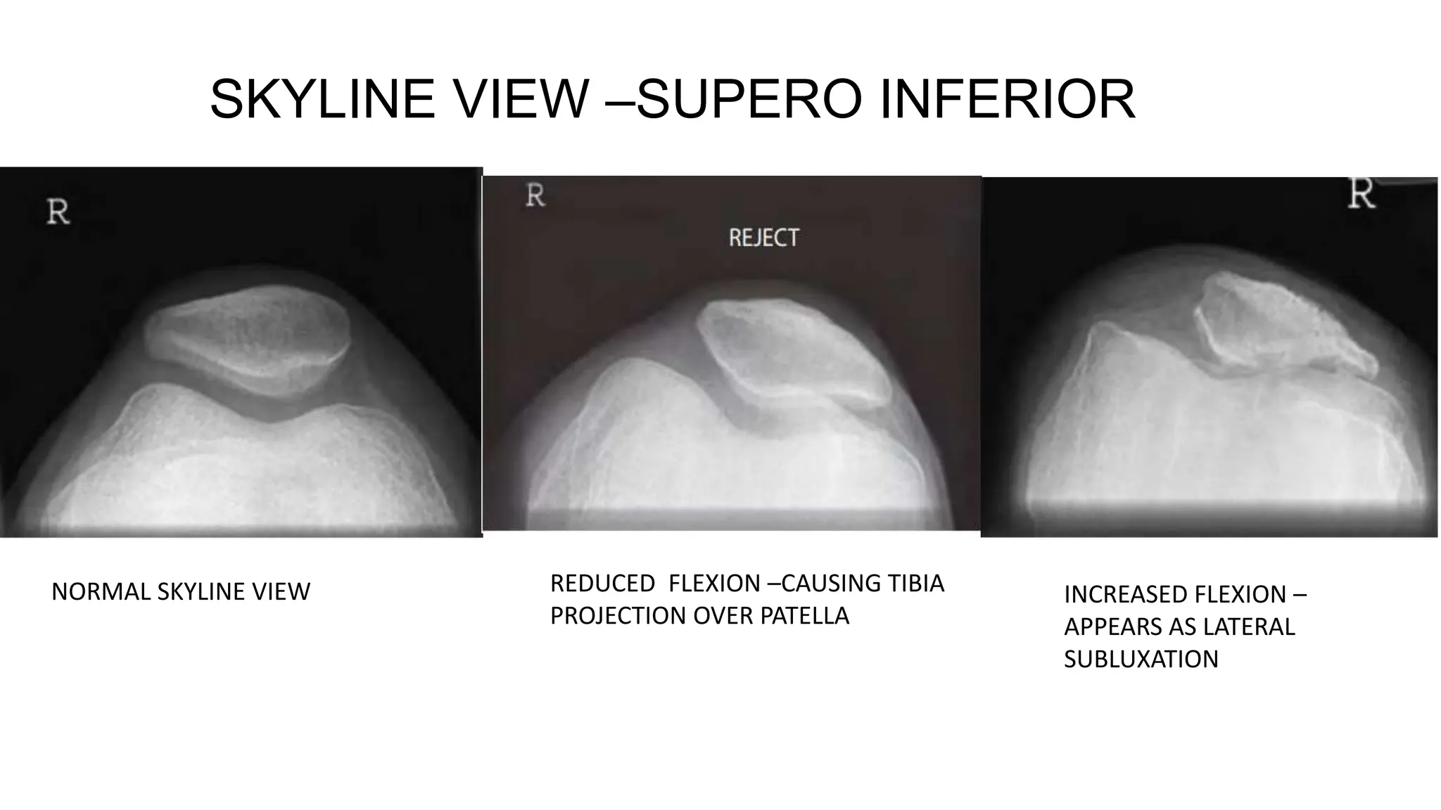 RADIOGRAPHIC ANATOMY OF KNEE JOINT AND ITS RADIOGRAPHIC VIEWS.pptx