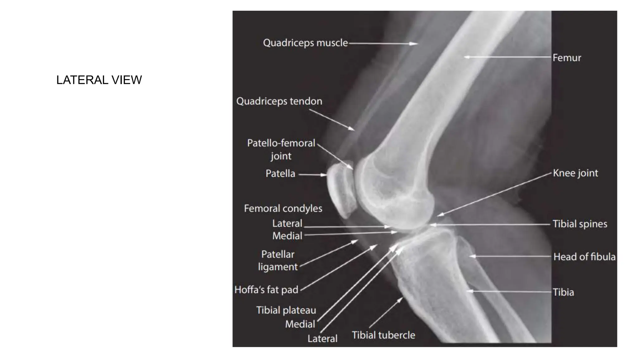 RADIOGRAPHIC ANATOMY OF KNEE JOINT AND ITS RADIOGRAPHIC VIEWS.pptx