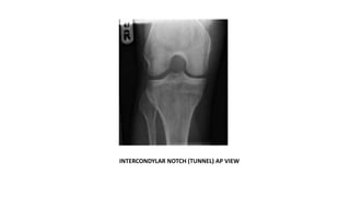 RADIOGRAPHIC ANATOMY OF KNEE JOINT AND ITS RADIOGRAPHIC VIEWS.pptx