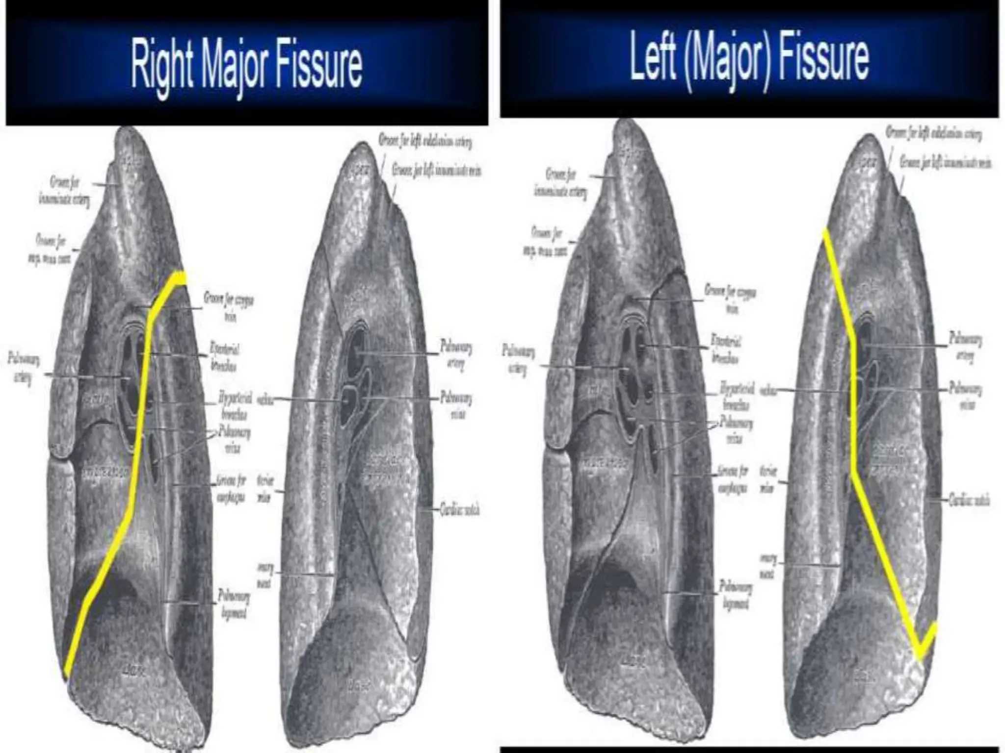 Radiographic anatomy of lungs.pptx