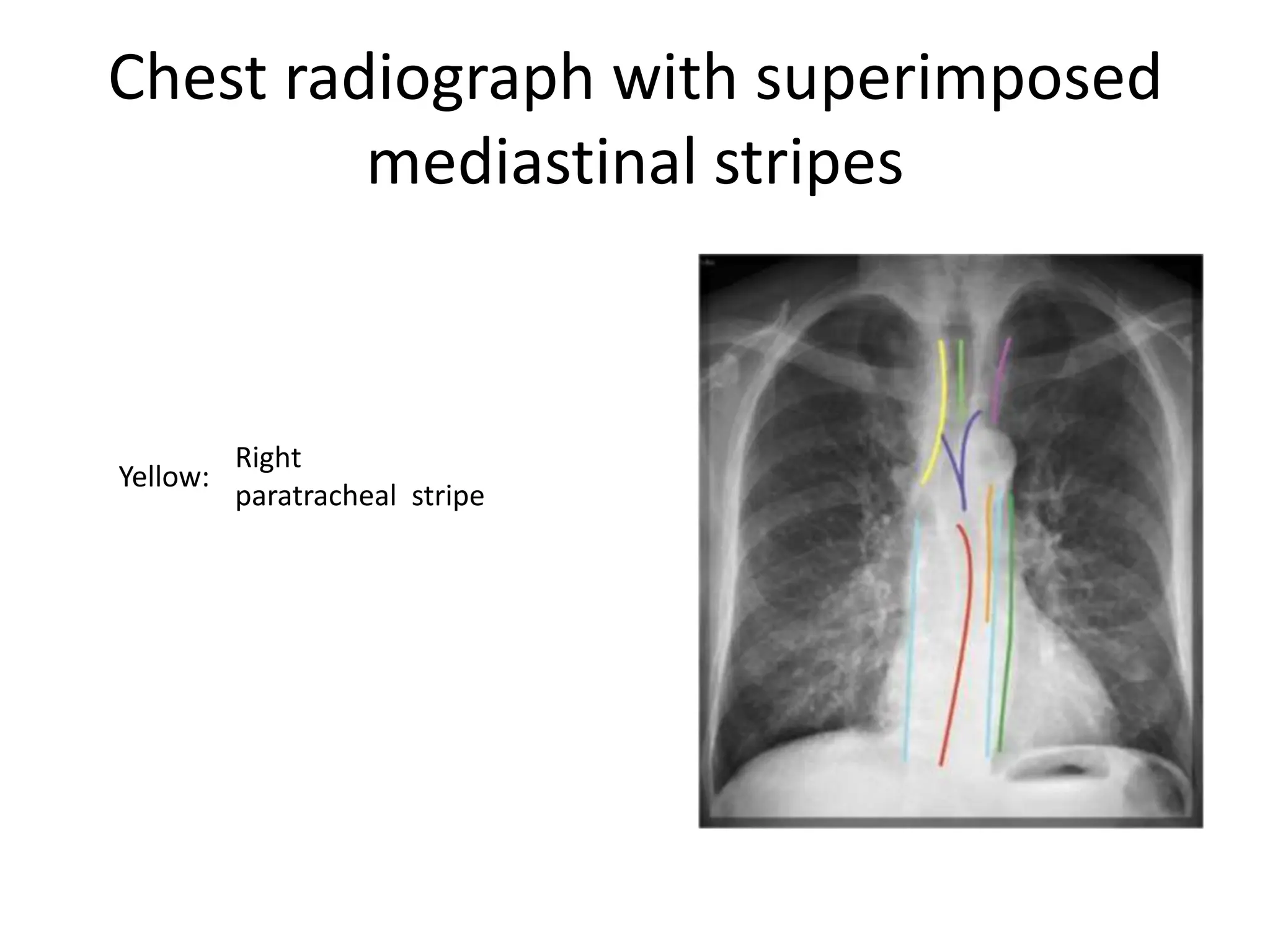 Radiographic anatomy of lungs.pptx
