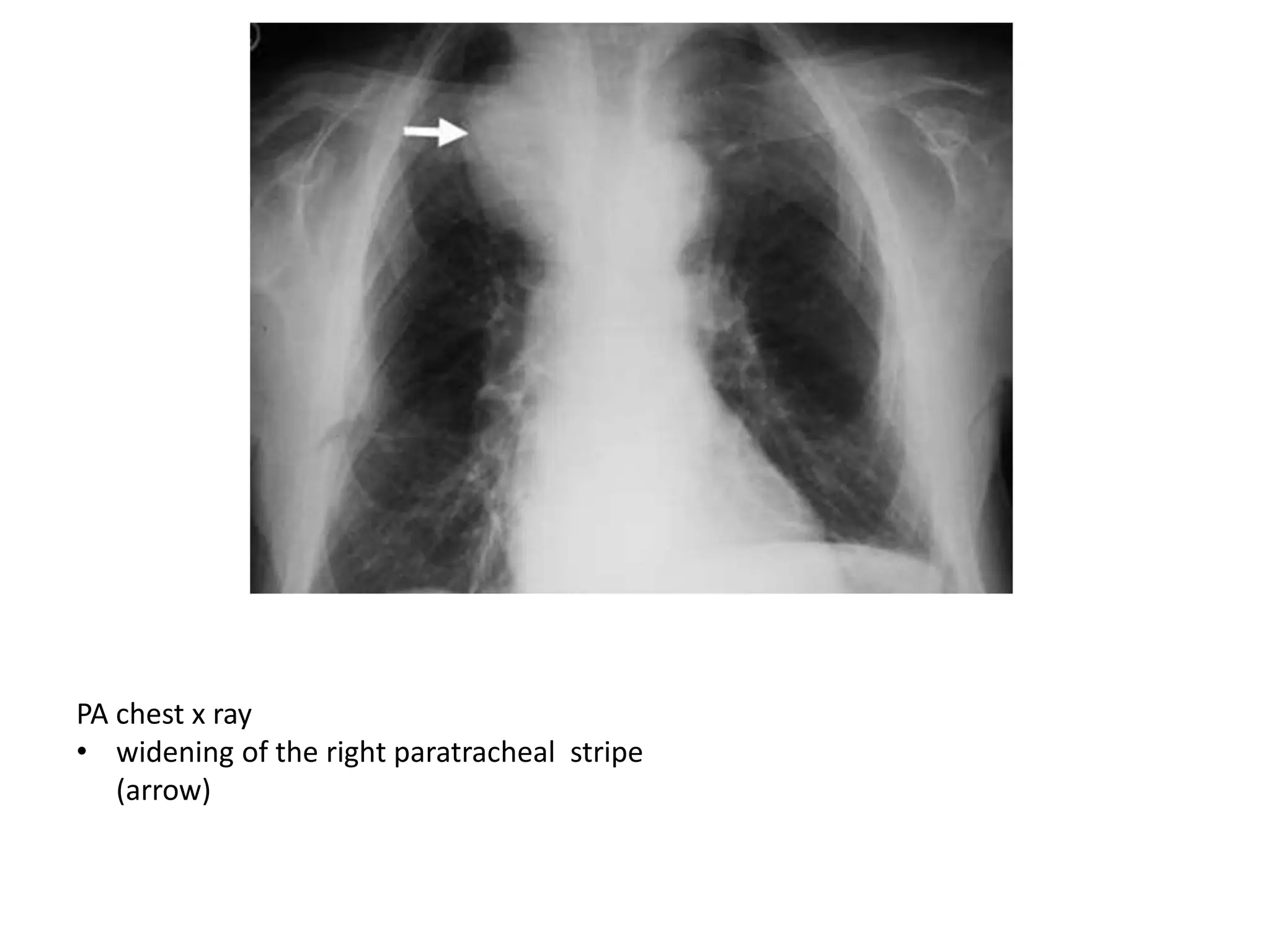 Radiographic anatomy of lungs.pptx