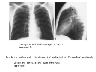 Radiographic anatomy of lungs.pptx