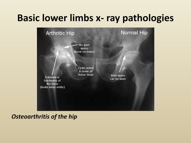 Radiographic Anatomy of the Lower Limbs.pptx | Death, Injury, or ...