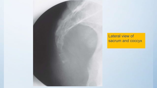 Radiographic anatomy of thoracic,lumbar spine, sacrum and coccyx | PPTX ...