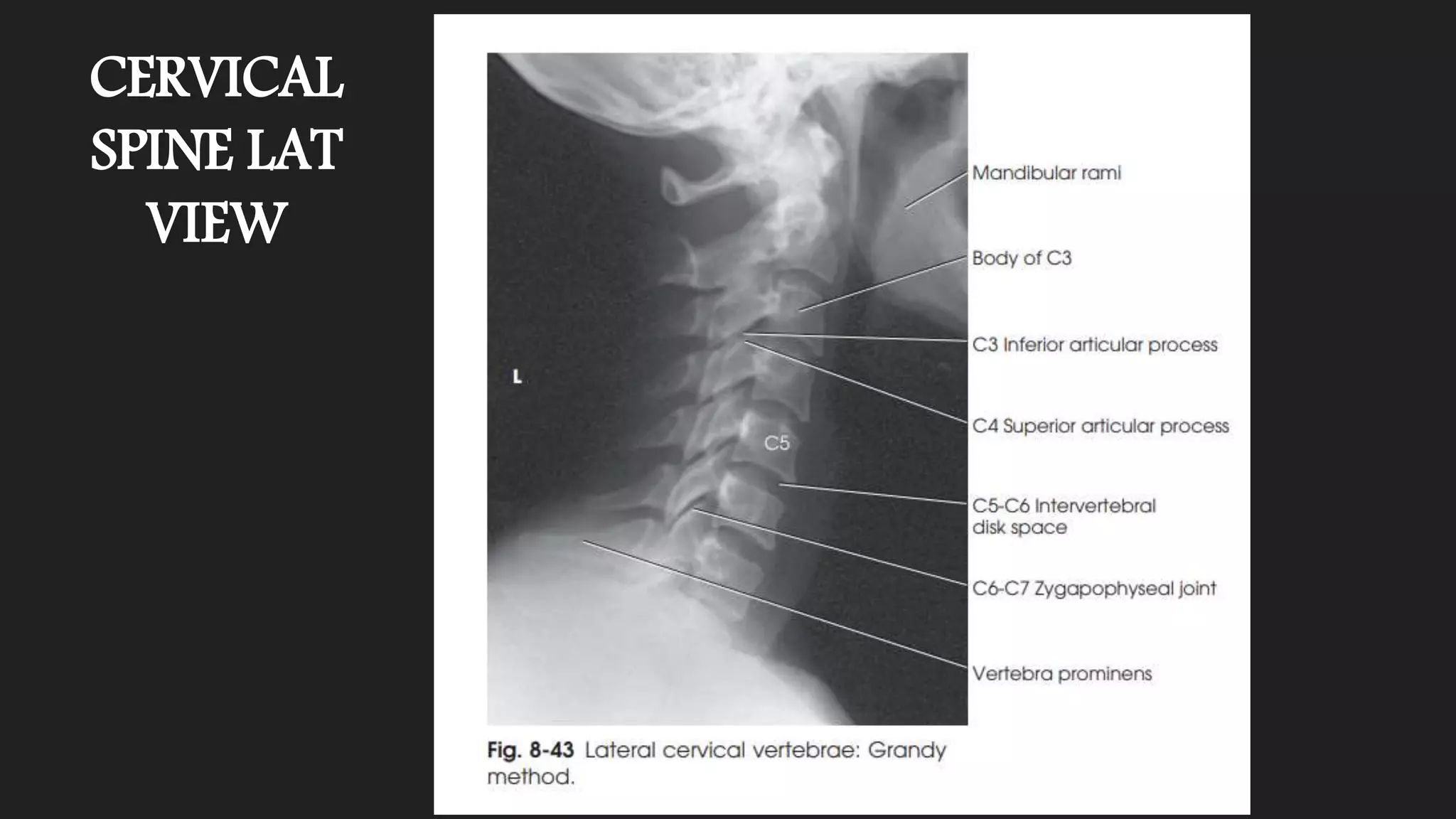 Radiographic anatomy of vertebral column | PPTX