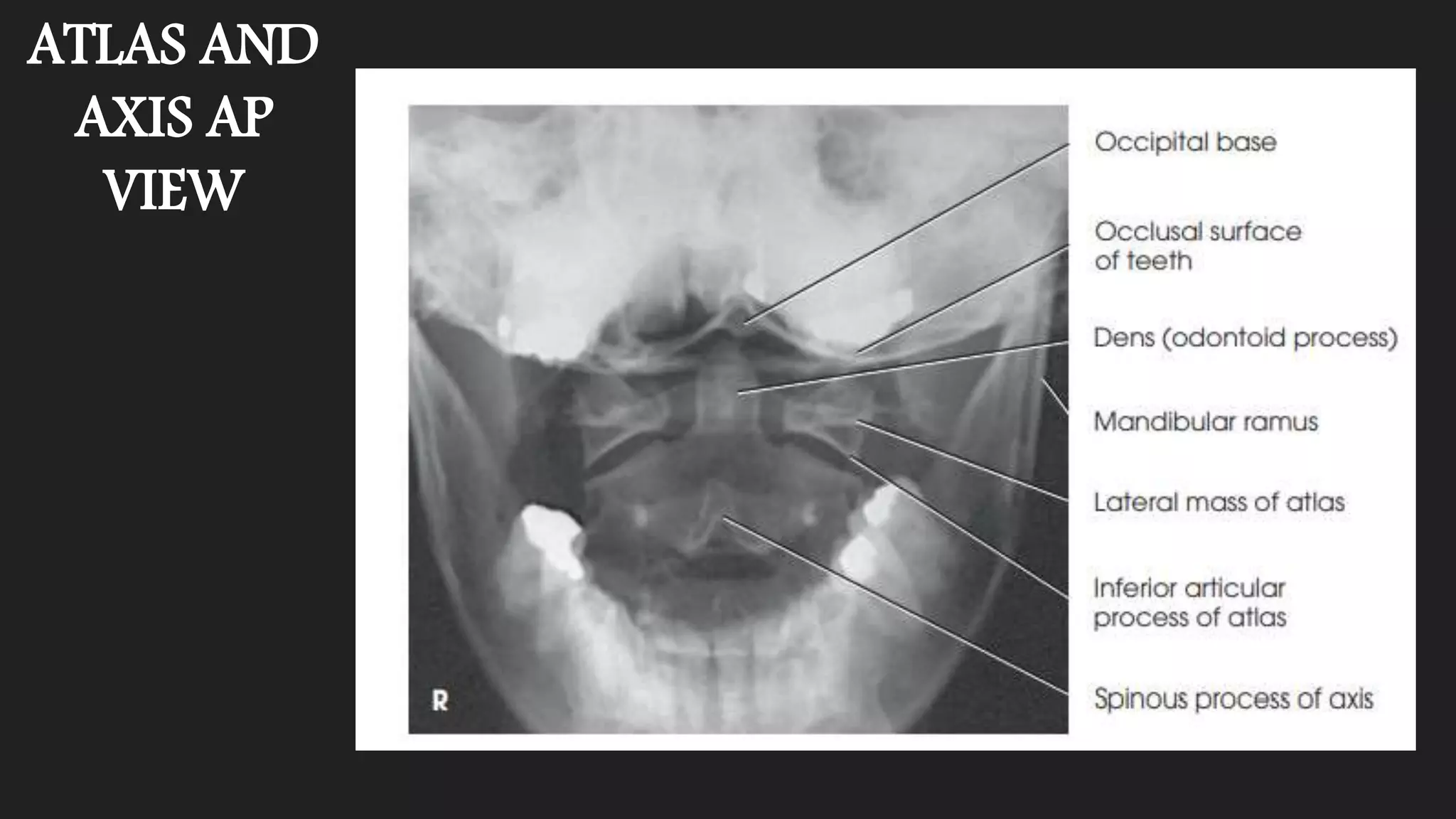 Radiographic anatomy of vertebral column | PPTX
