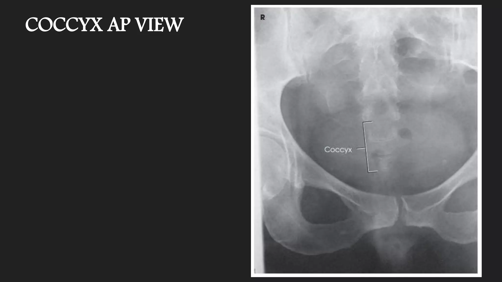 Radiographic anatomy of vertebral column | PPTX