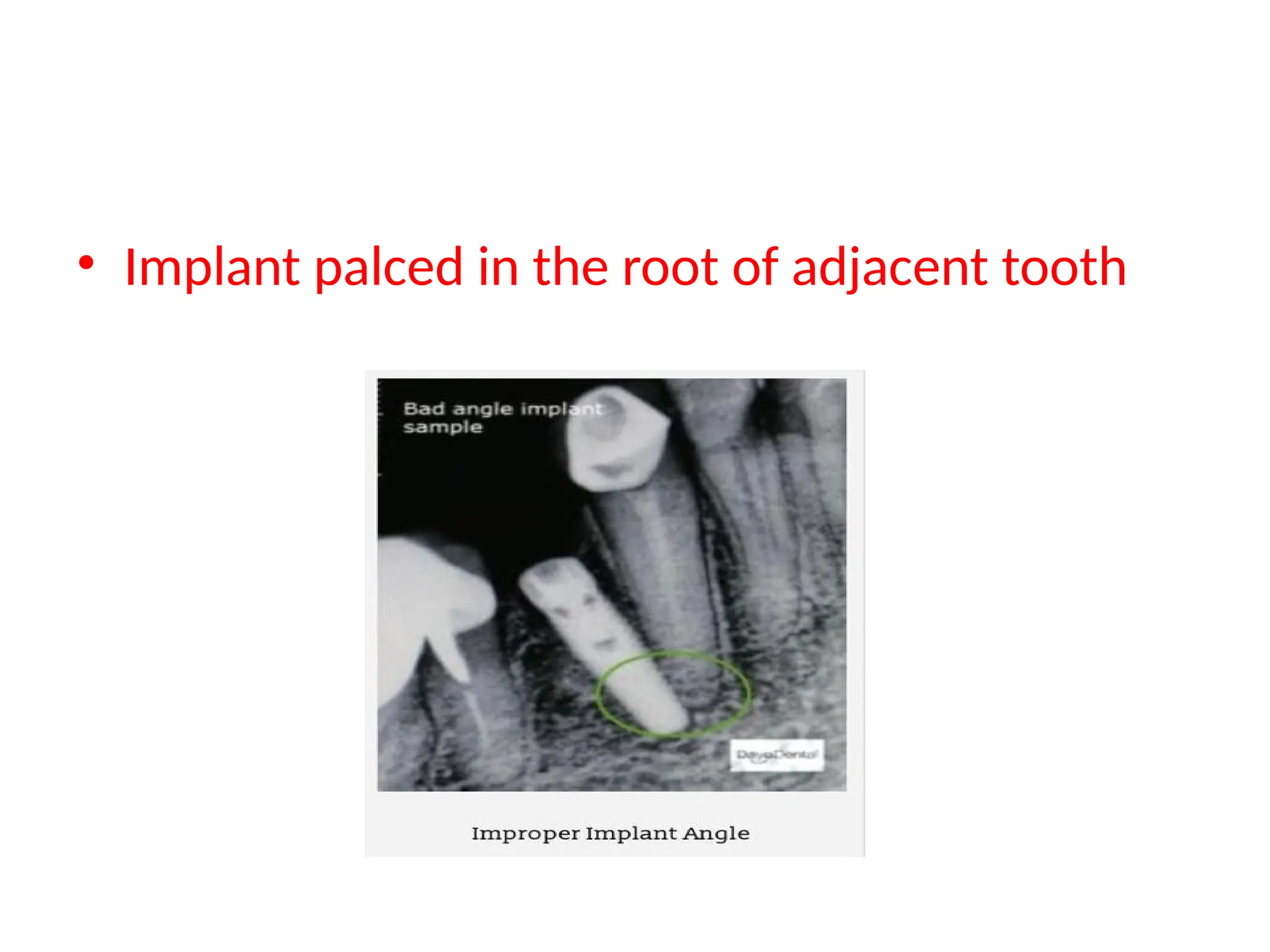 radiographic appearance of dental implant complications.pptx