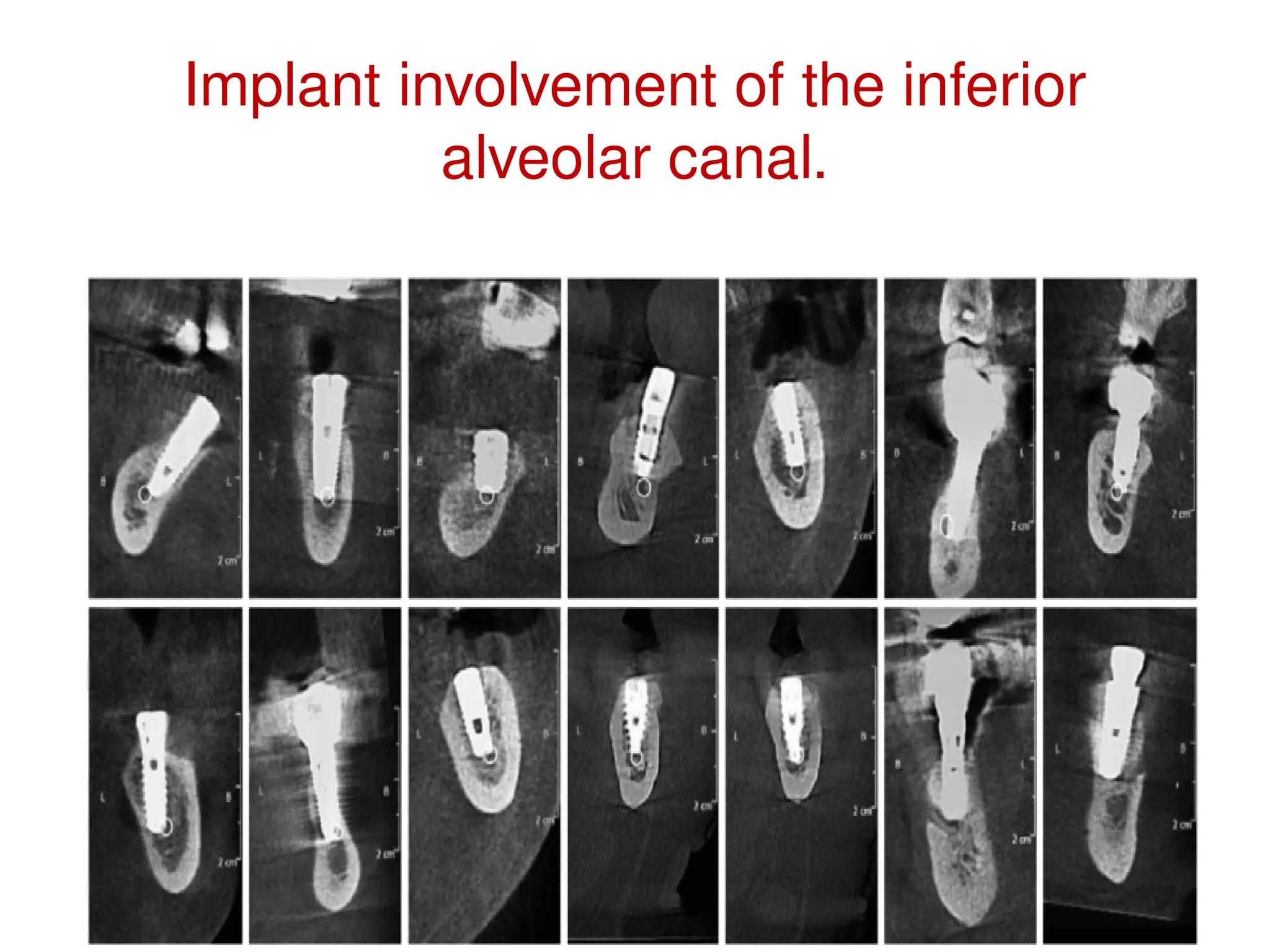 radiographic appearance of dental implant complications.pptx