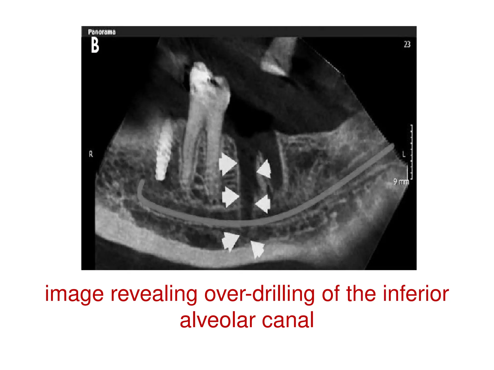 radiographic appearance of dental implant complications.pptx