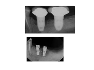 radiographic appearance of dental implant complications.pptx