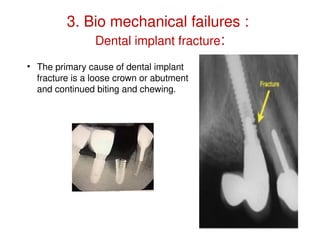 radiographic appearance of dental implant complications.pptx