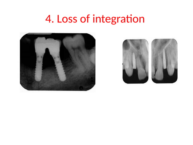 radiographic appearance of dental implant complications.pptx