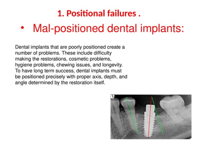 radiographic appearance of dental implant complications.pptx